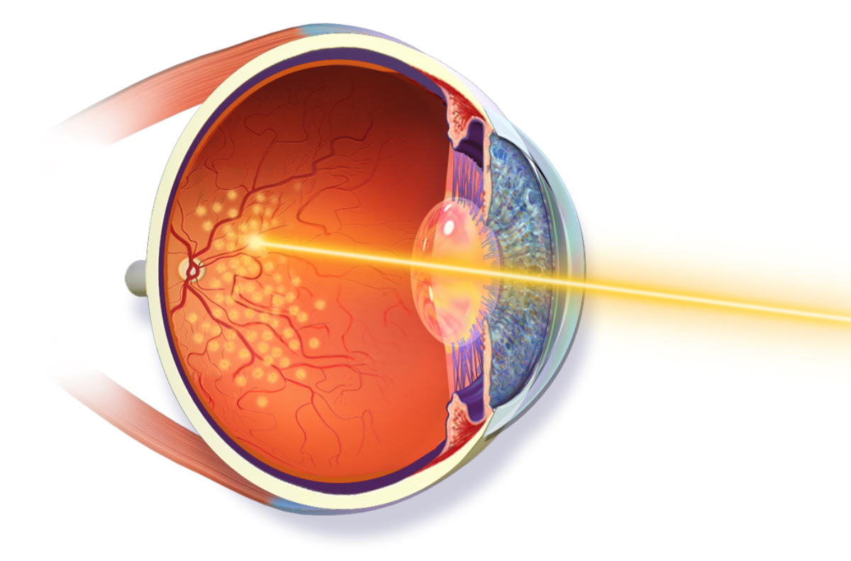 Laser quang đông võng mạc